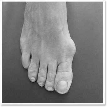 ALLUCE VALGO CHIRURGIA | MASSIMO DROMMI